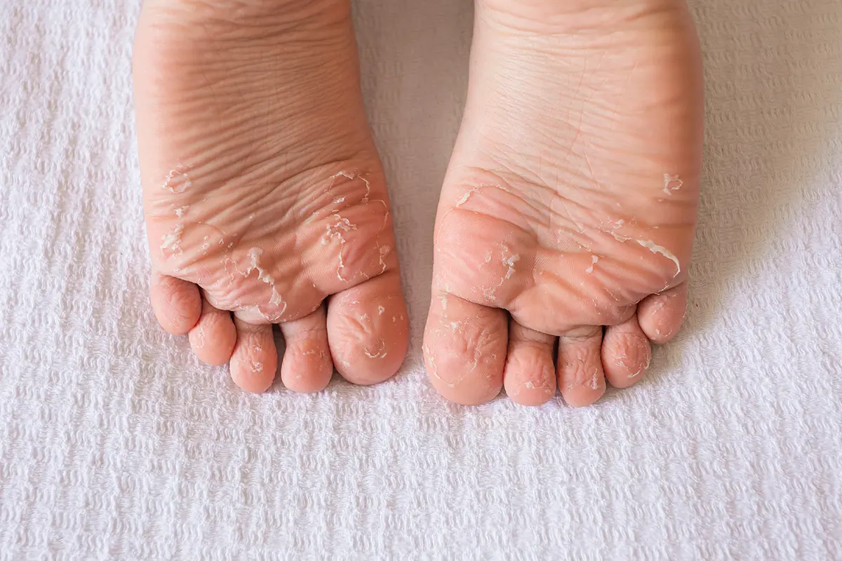 Why Are My Child’s Feet Peeling?